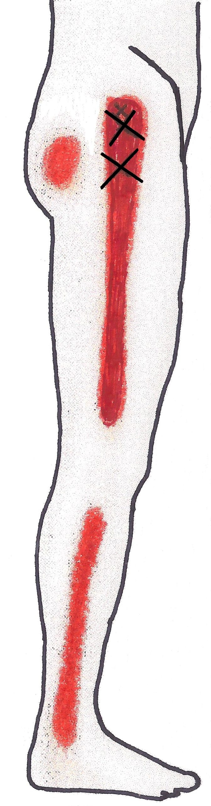 Triggerpunkt-Therapie - Physiotherapie am Haggen